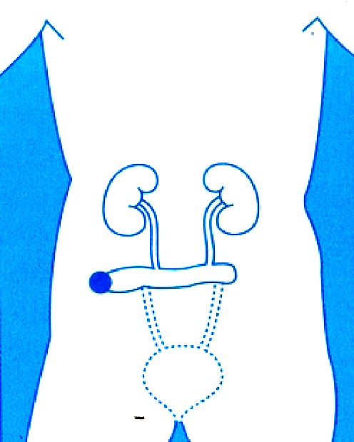 Urostomia – APISTOM