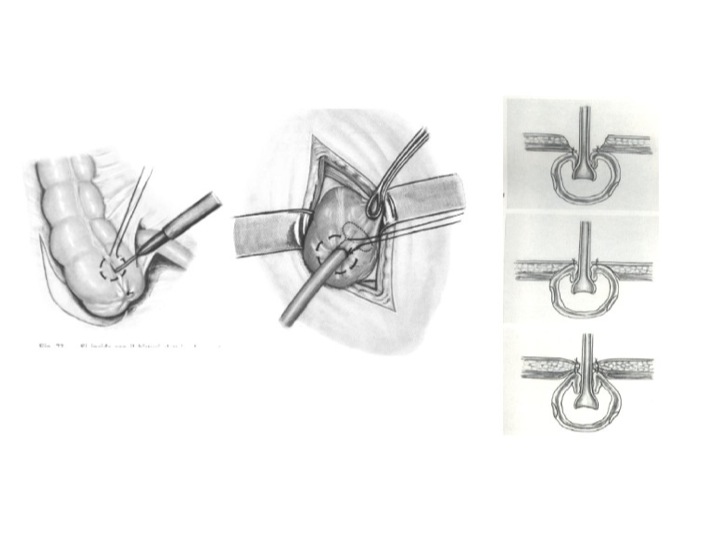 Le stomie – APISTOM